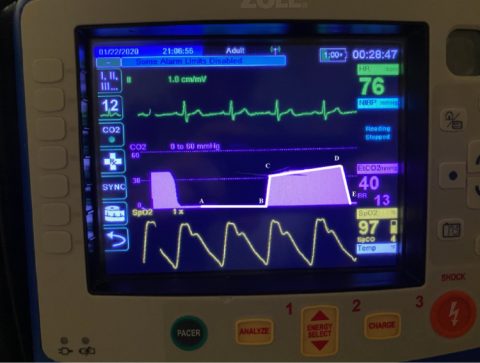 Using EtCO2 to Make the Most of Your Pain Management Care - EMS Airway