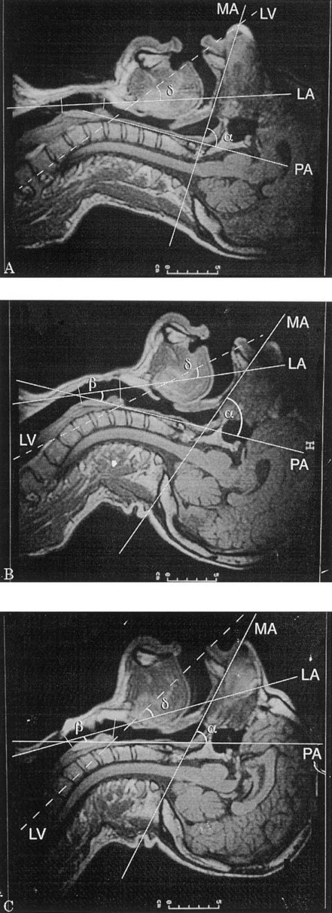 The Importance of Head Positioning During Endotracheal Intubation - EMS ...
