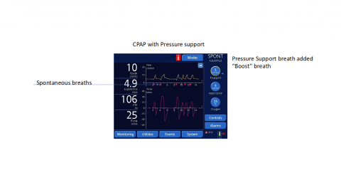 Demystifying Ventilator Modes: It’s Not That Complicated! - EMS Airway